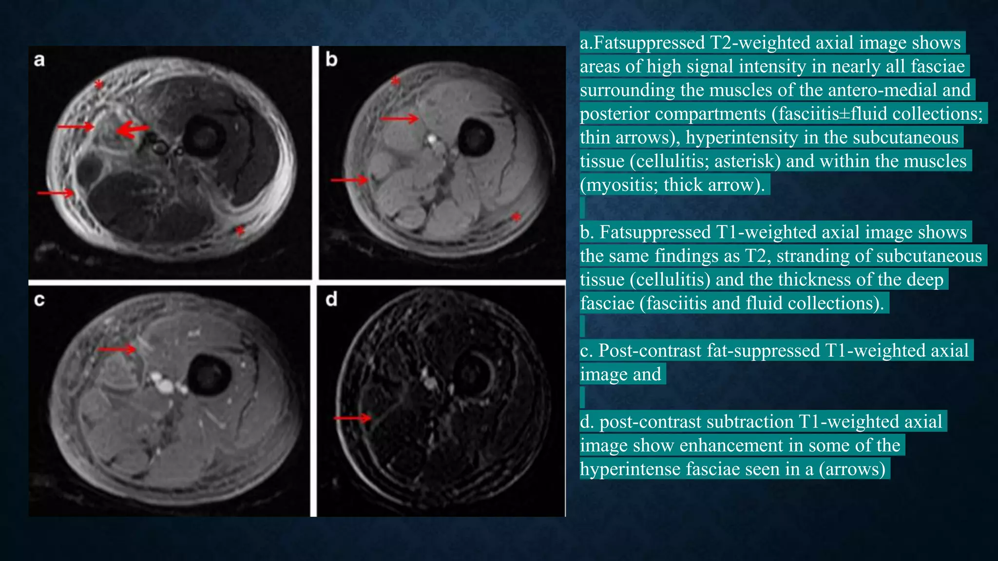 NECROTIZING SOFT TISSUE INFECTION.pptx