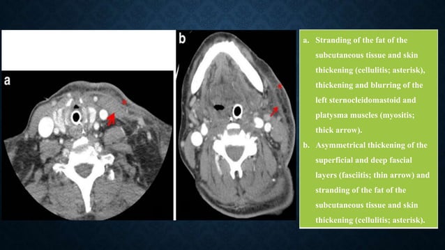 NECROTIZING SOFT TISSUE INFECTION.pptx | Skin and Dermatology ...