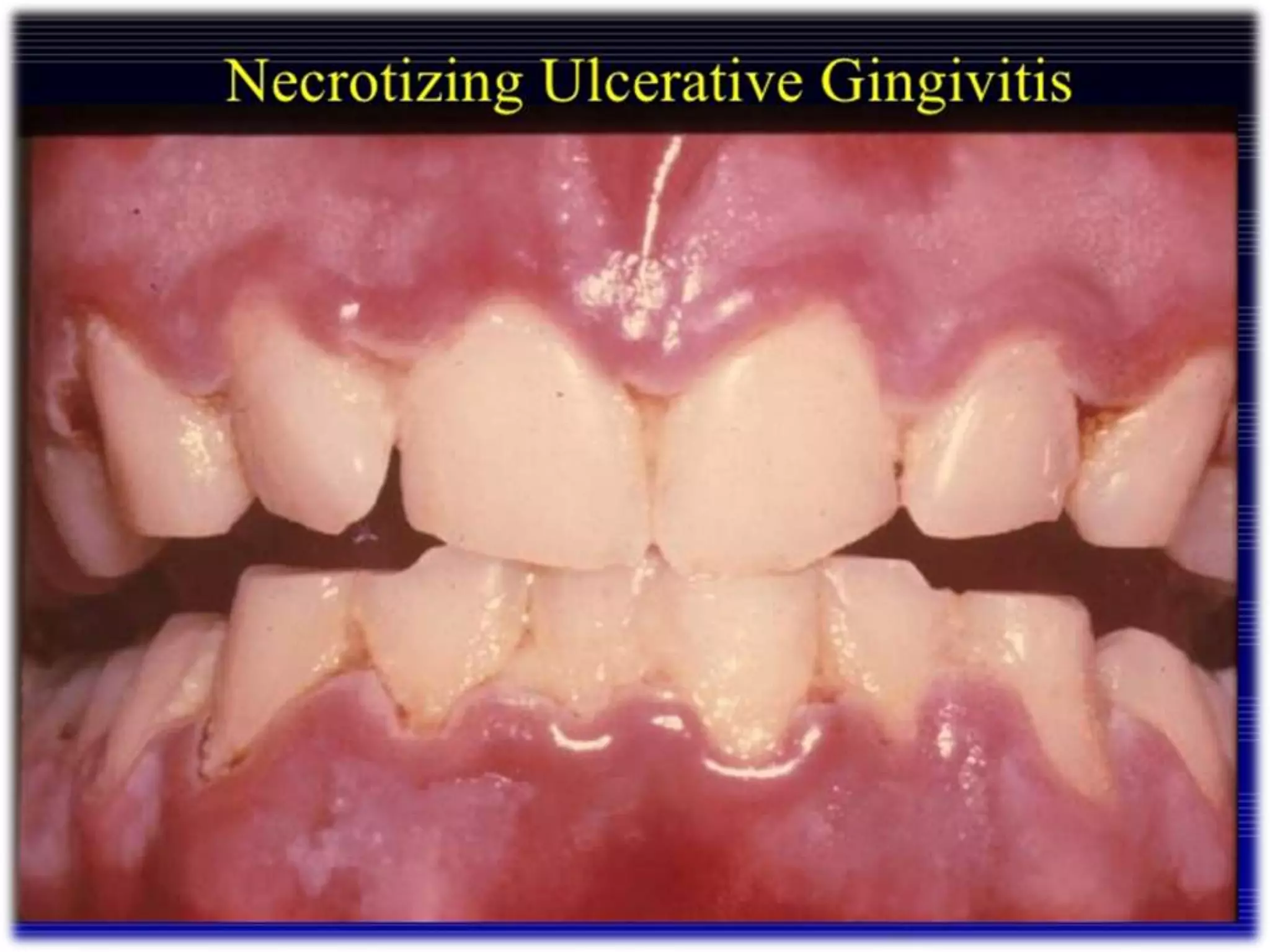 Necrotizing ulcerative gingivitis | PPTX