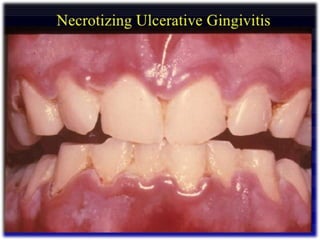 Necrotizing ulcerative gingivitis | PPTX
