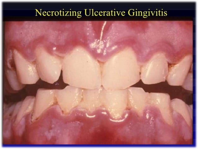 Necrotizing ulcerative gingivitis | PPTX | Dental Health | Diseases and ...