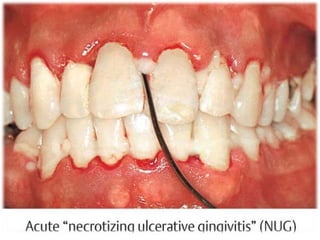 Acute Necrotizing Ulcerative Gingivitis