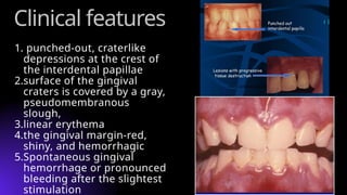 NECROTIZING ULCERATIVE GINGIVITIS in perio.pptx
