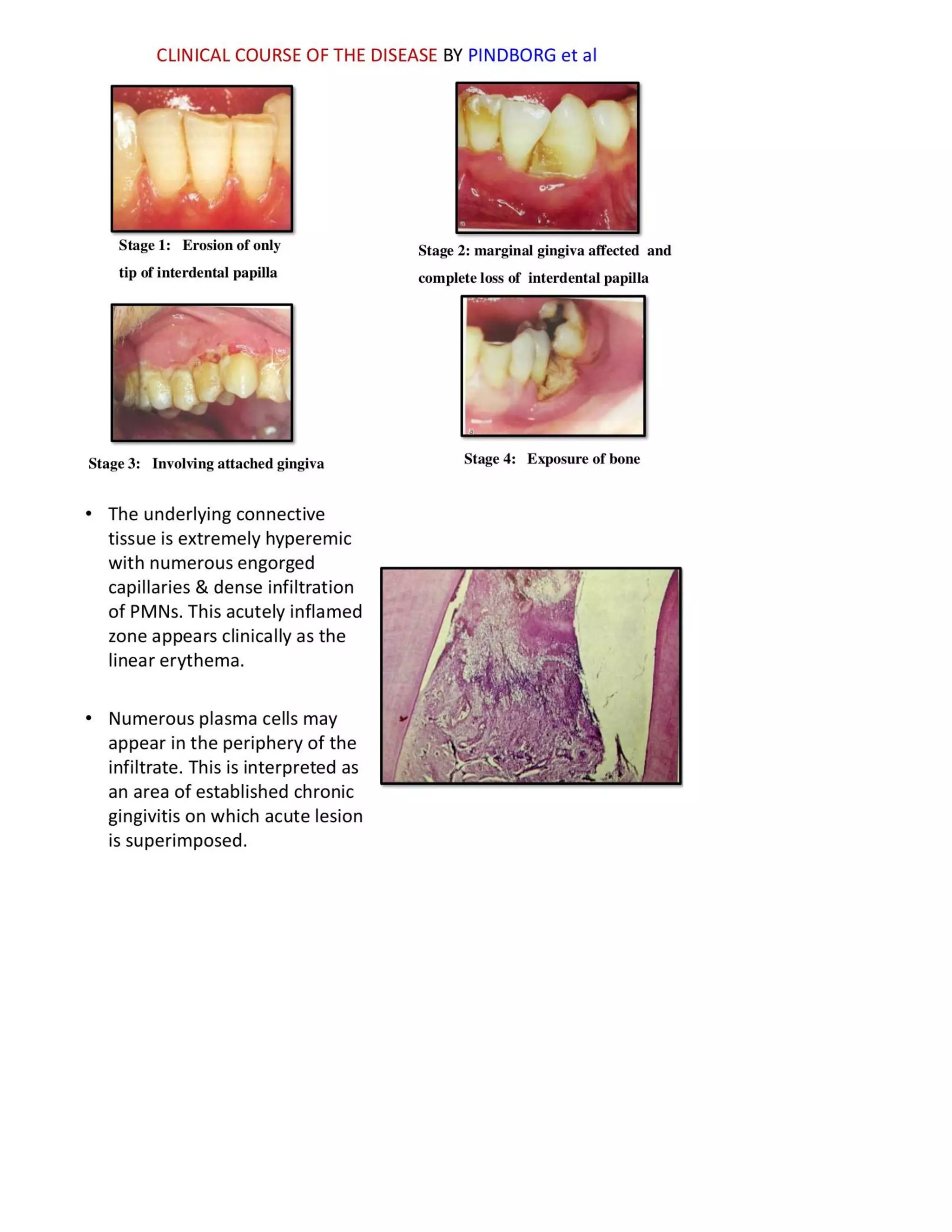 Necrotizing ulcerative gingivitis and necrotizing ulcerative ...