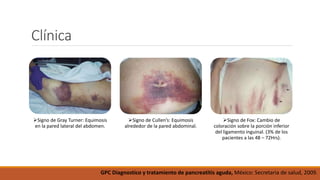 Pancreatitis | PPTX