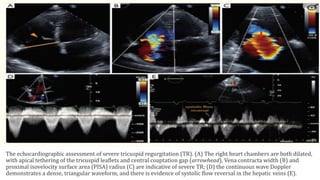neduri vinod kumar, 73B, internal medicine, tricuspid regurgitation ppt ...