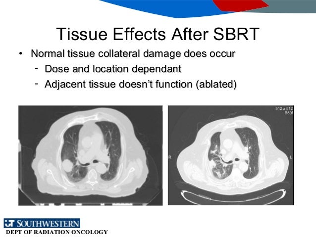 sbrt for inoperable lung cancer