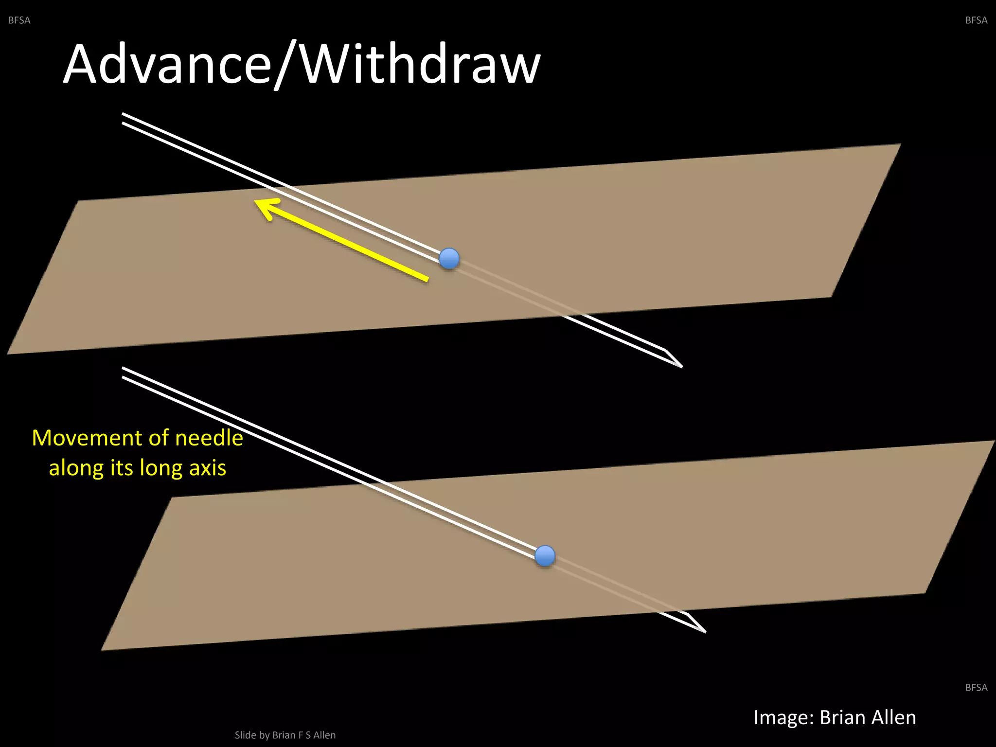 Needle probe movement for regional anesthesia | PPTX