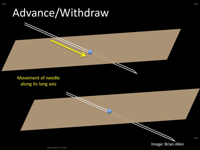 Needle probe movement for regional anesthesia | PPT