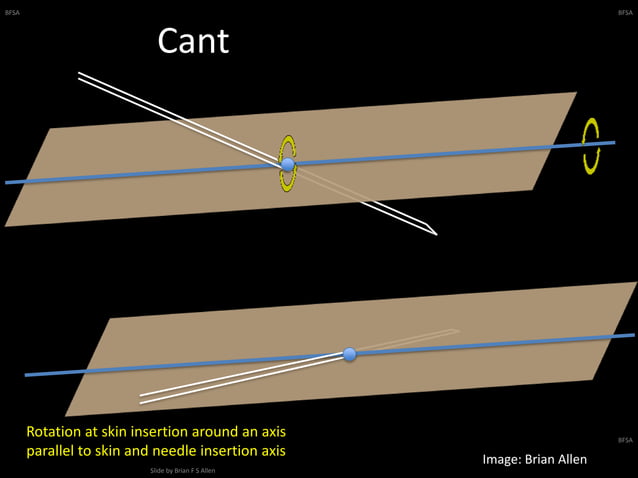 Needle probe movement for regional anesthesia | PPT