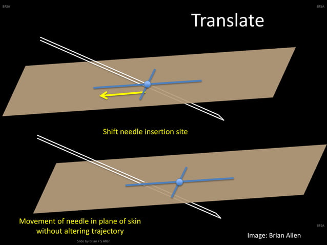 Needle probe movement for regional anesthesia | PPT