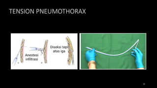 NEEDLE THORACOCENTESIS WSD.pptx