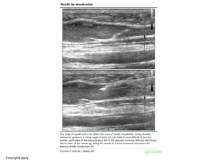 Needle tip visualization | PPT
