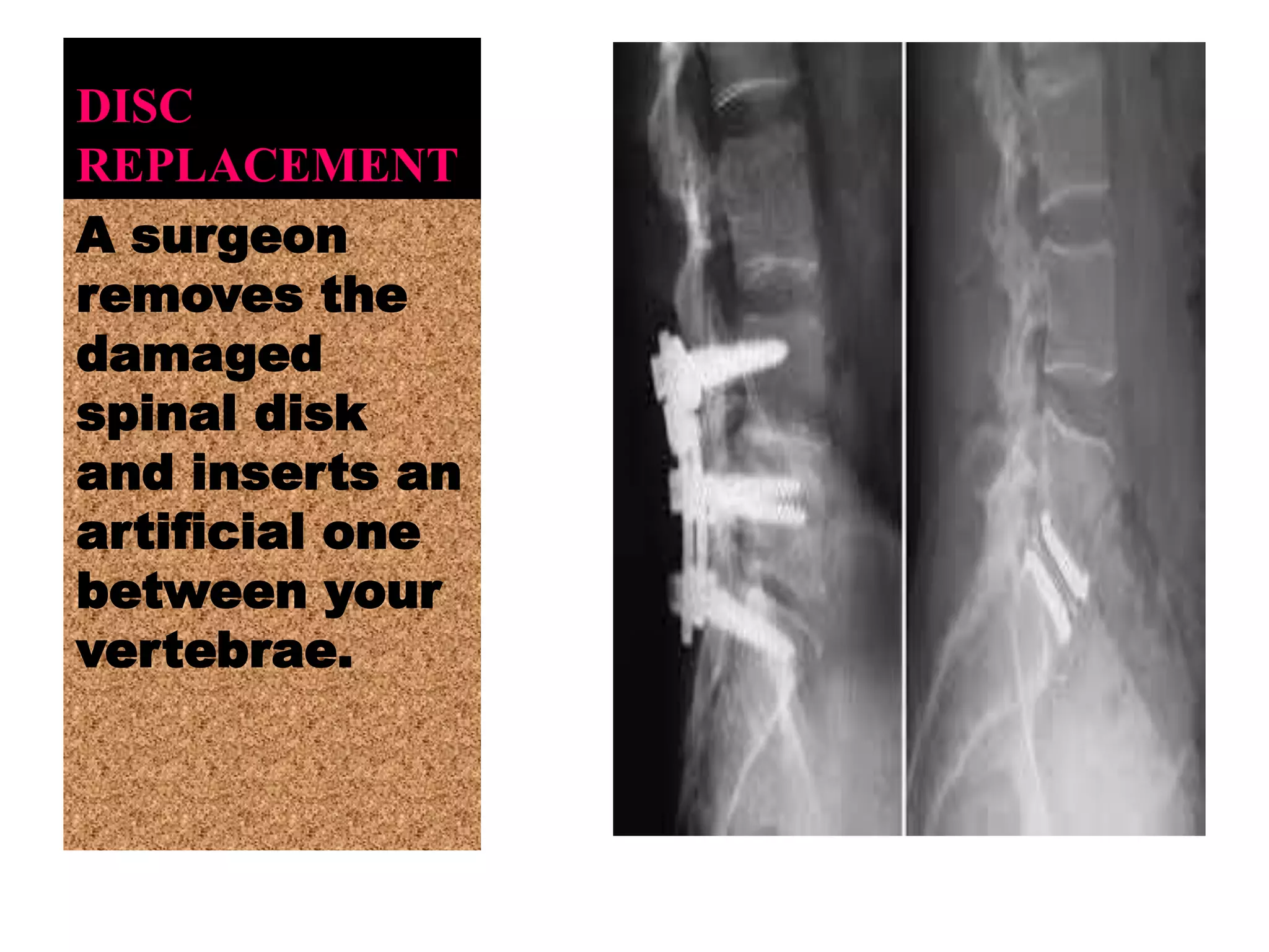 spinal cord injury ppt | PPTX