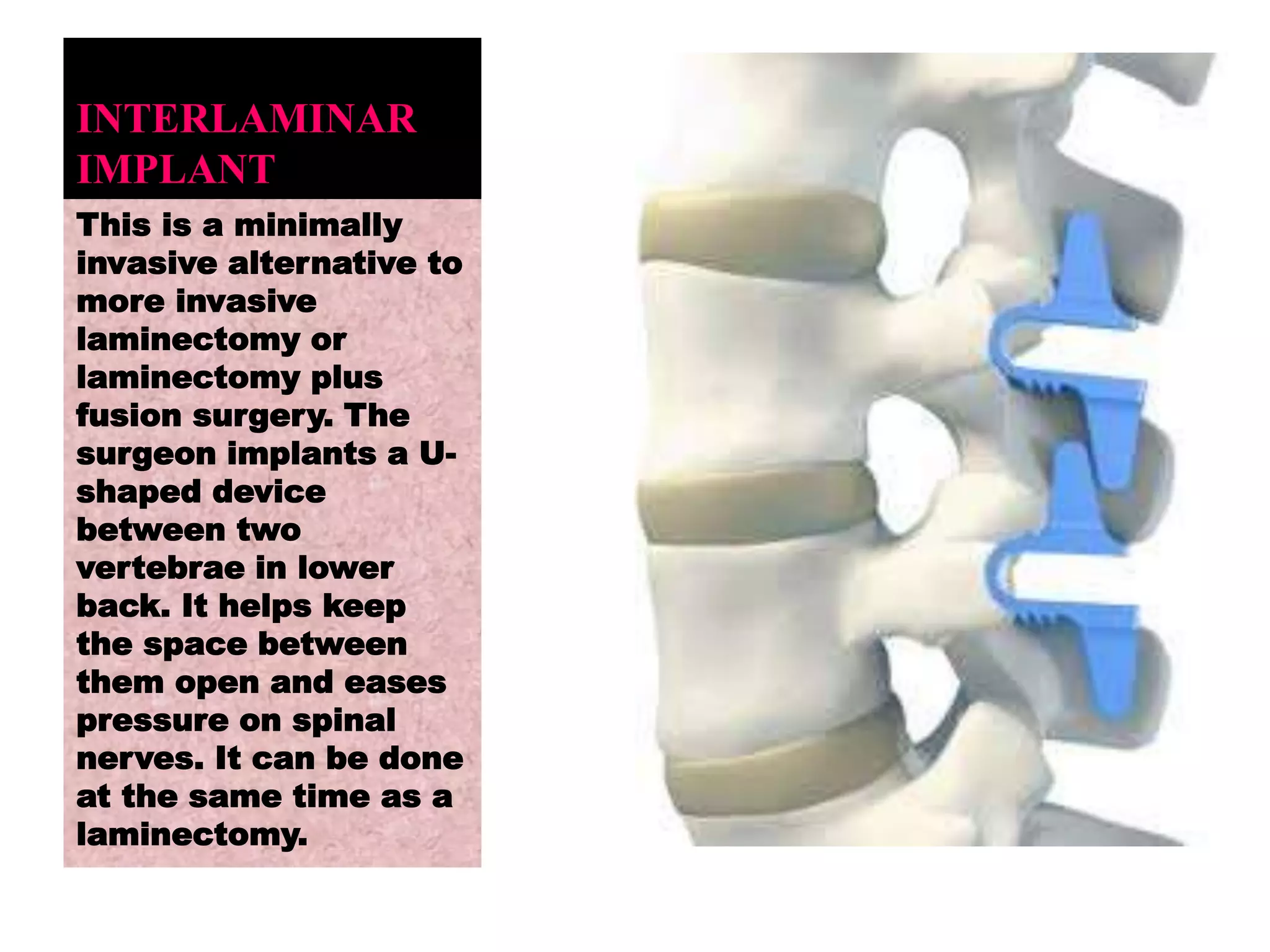 spinal cord injury ppt | PPTX