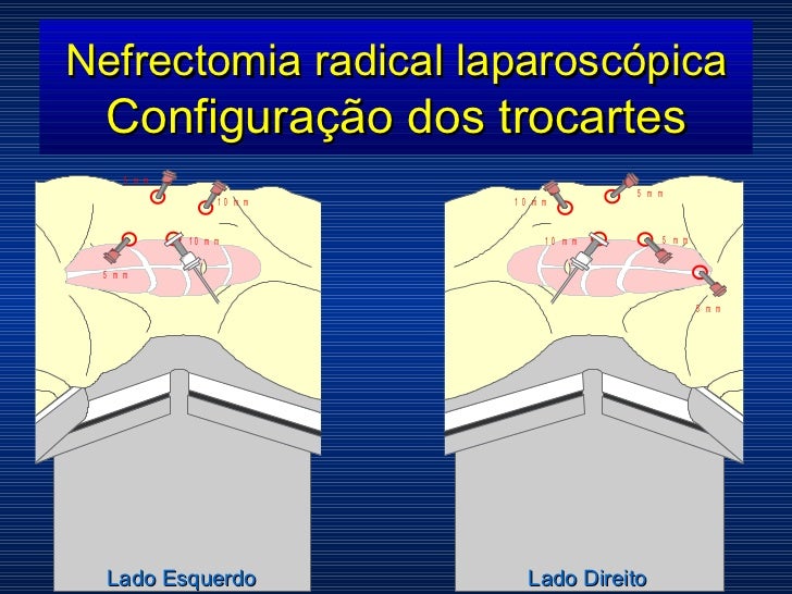 Nefrectomia radical laparoscópica