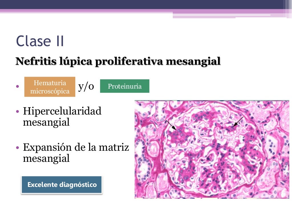 Nefritis lupica