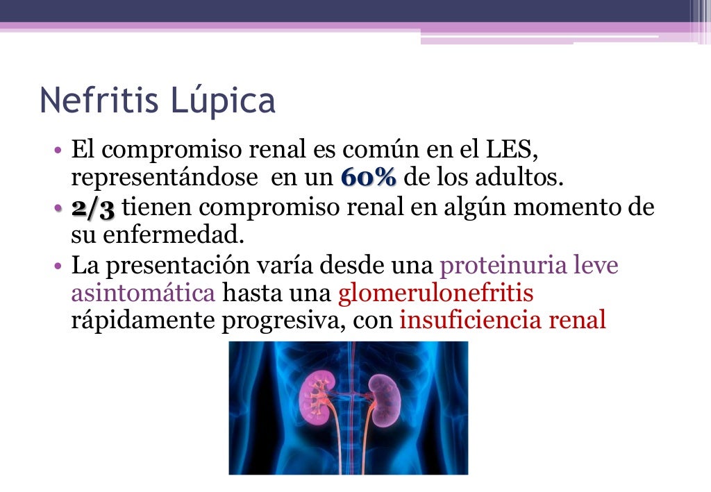 Nefritis lupica