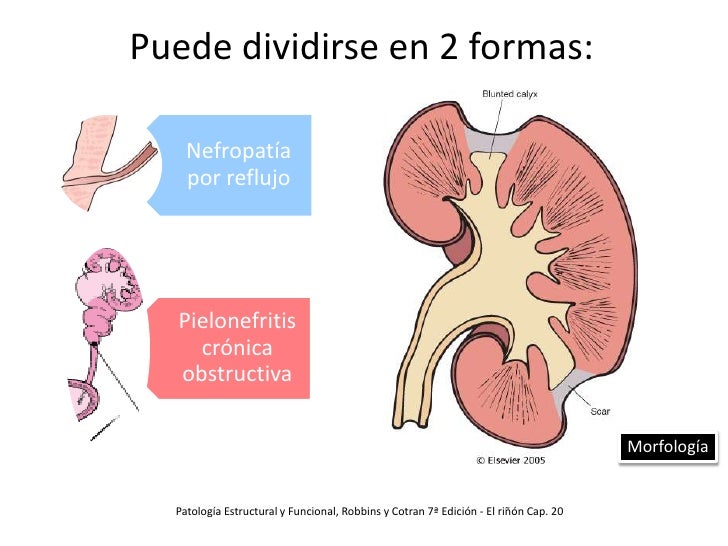 Nefritis Tubulointersticial