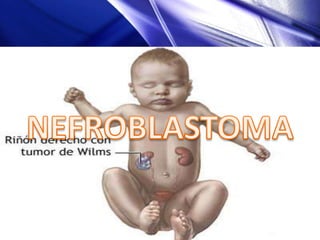 Nefroblastoma | PPTX