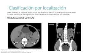 Tratamiento, fisiopatología de NEFROCALCINOSIS.pptx