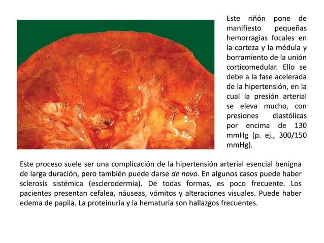 Nefroesclerosis | PPTX
