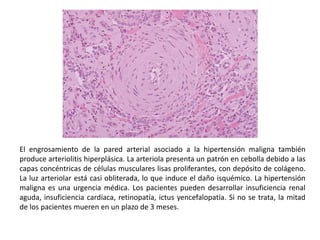 Nefroesclerosis | PPTX
