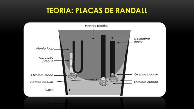 NEFROLOGIA CLINICA: Nefrolitiasis