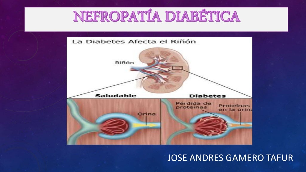 Nefropatía diabética.
