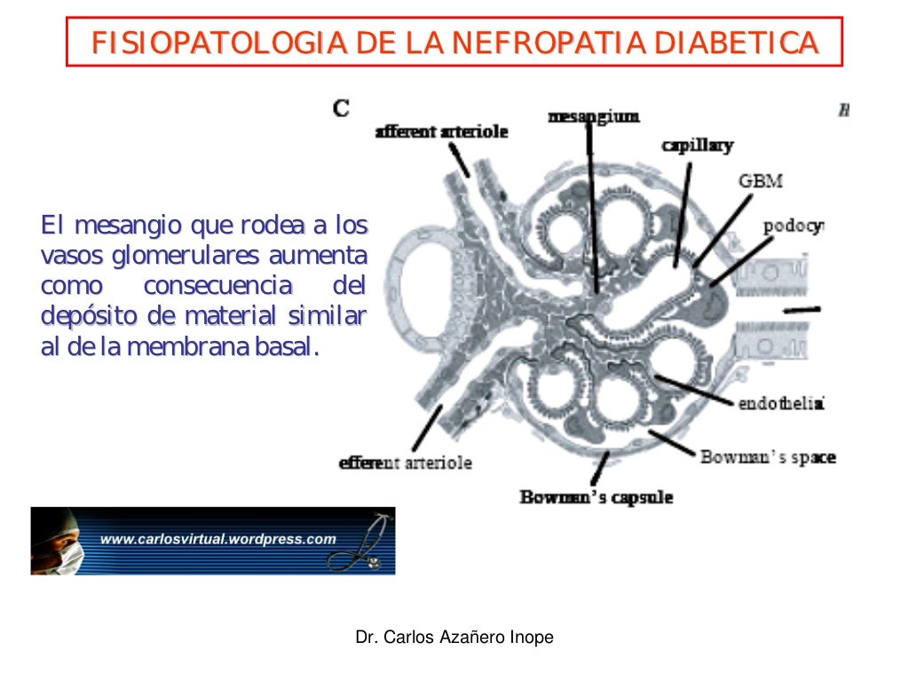 Nefropatia Diabetica