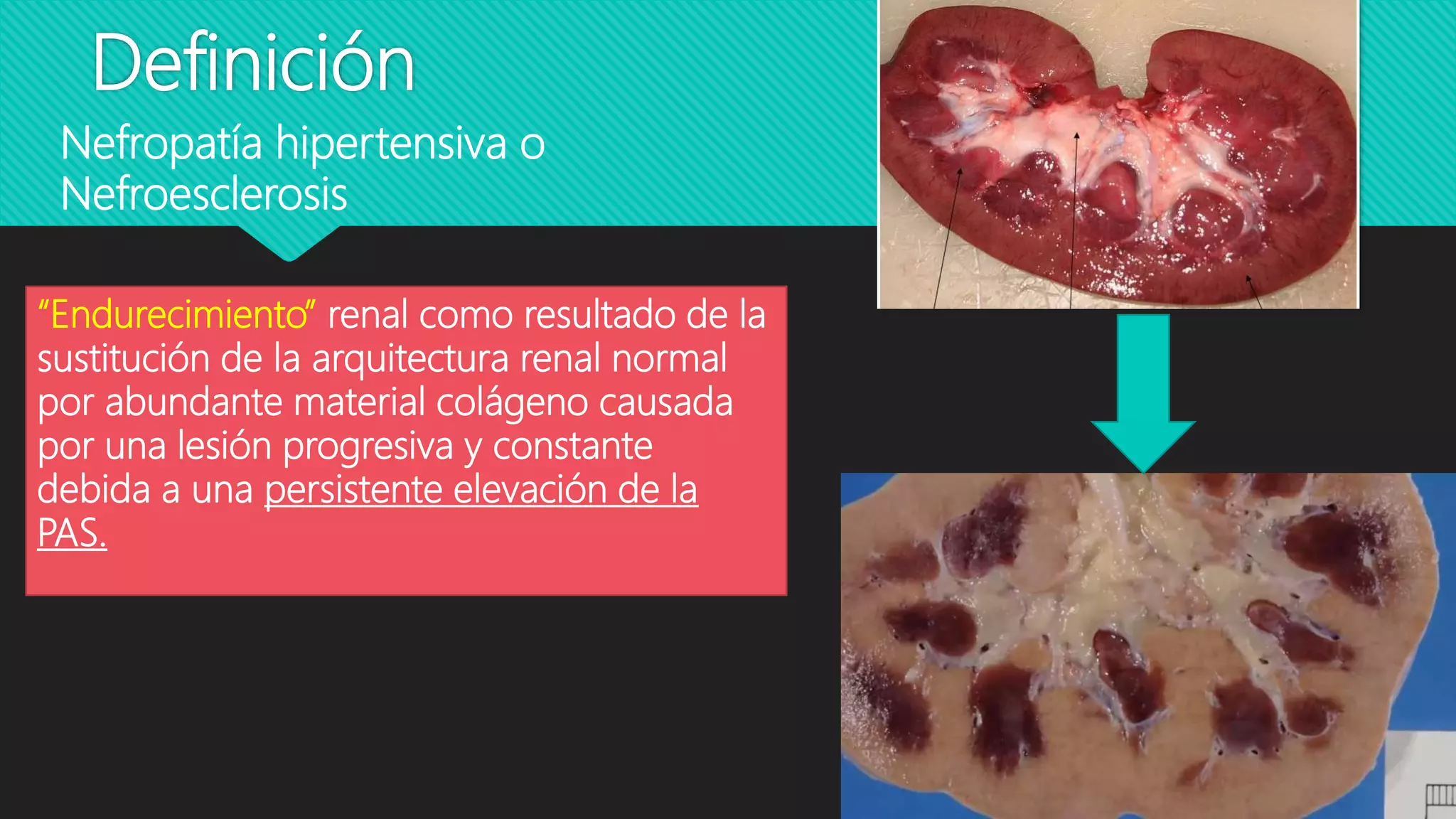 Nefropatia hipertensiva, nefroesclerosis | PPT