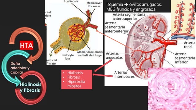 Nefropatia hipertensiva, nefroesclerosis