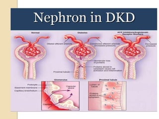 Nefropati diabetik -sony | PPTX