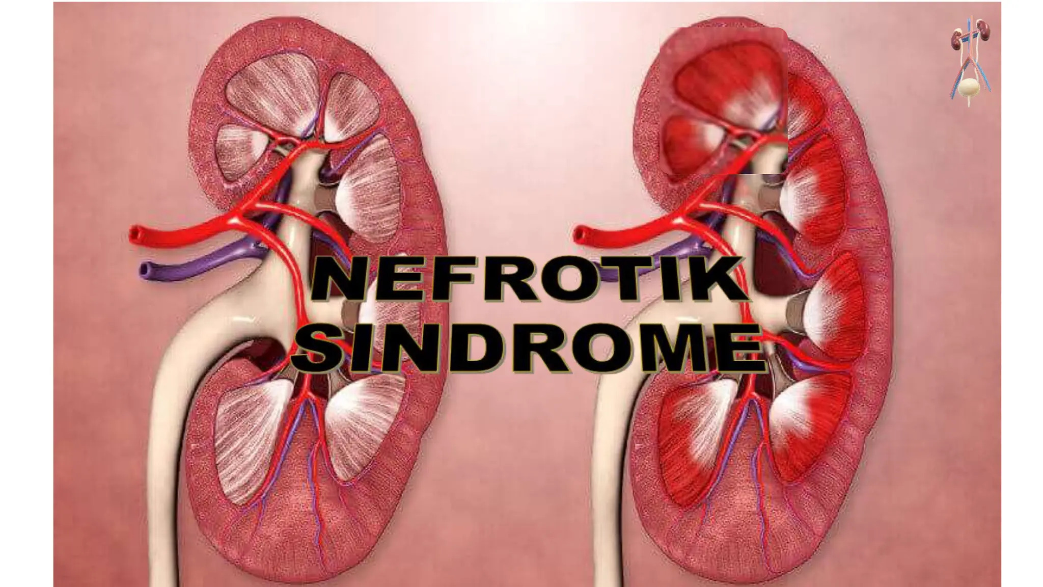 NEFROTIK SINDROME.pptx