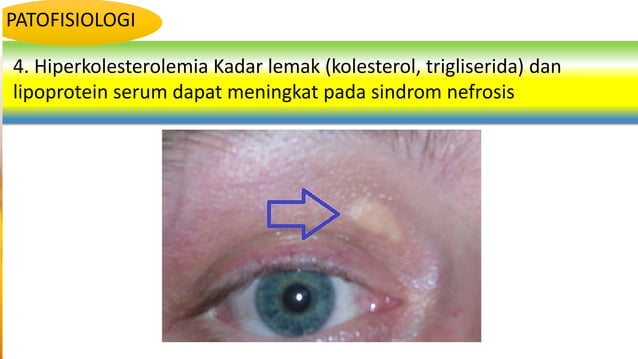 NEFROTIK SINDROME.pptx