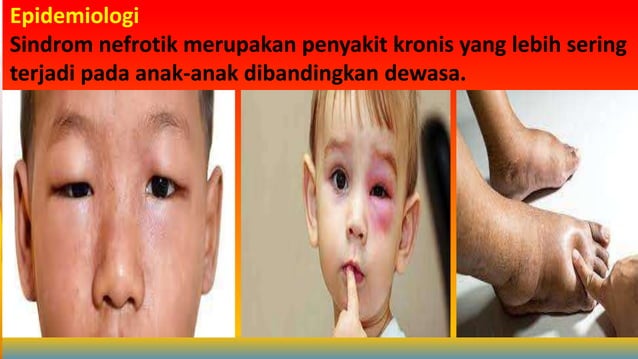 NEFROTIK SINDROME.pptx
