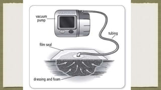 Negative Pressure Therapy.pptx