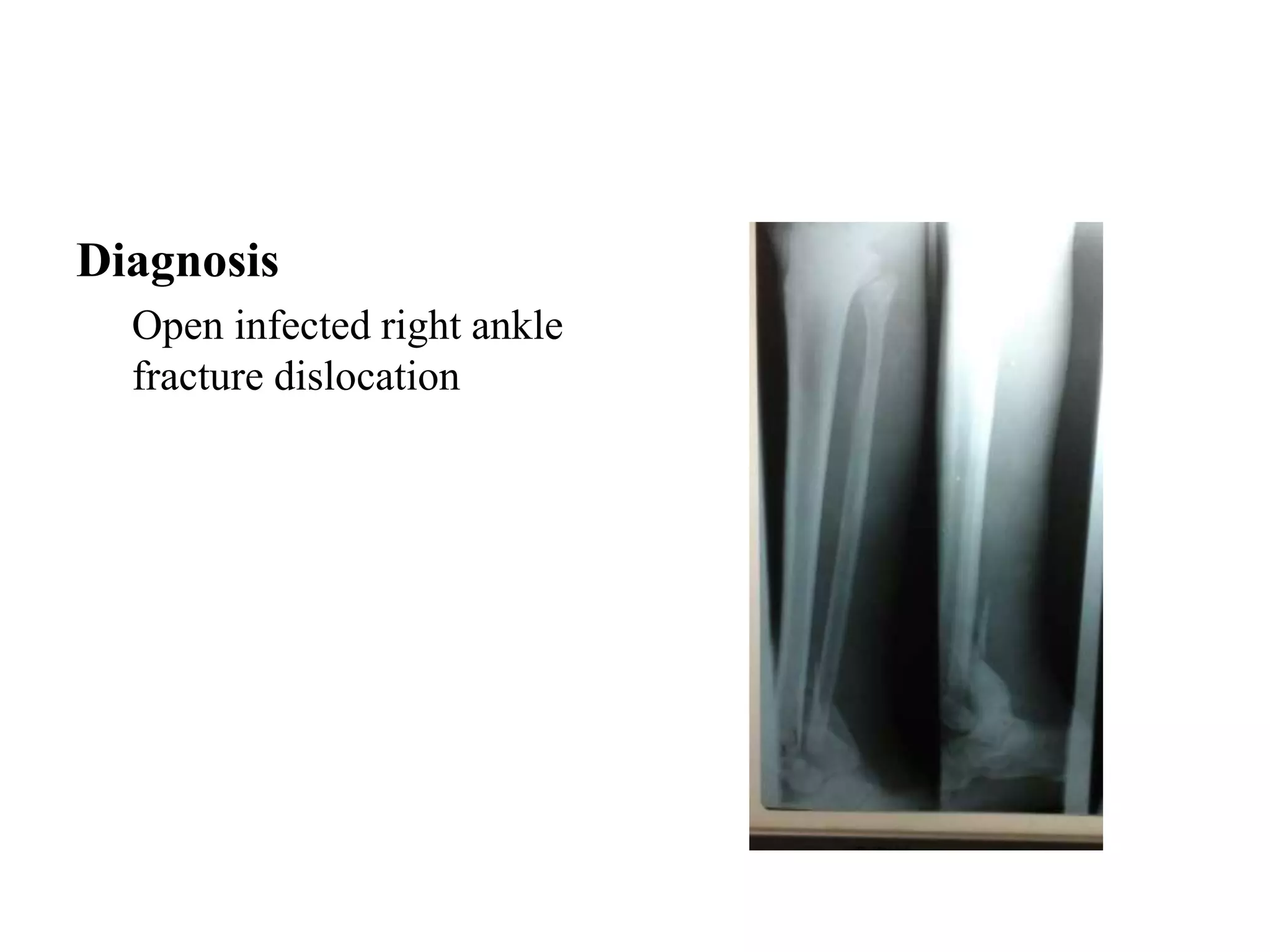Negative pressure wound therapy | PPTX