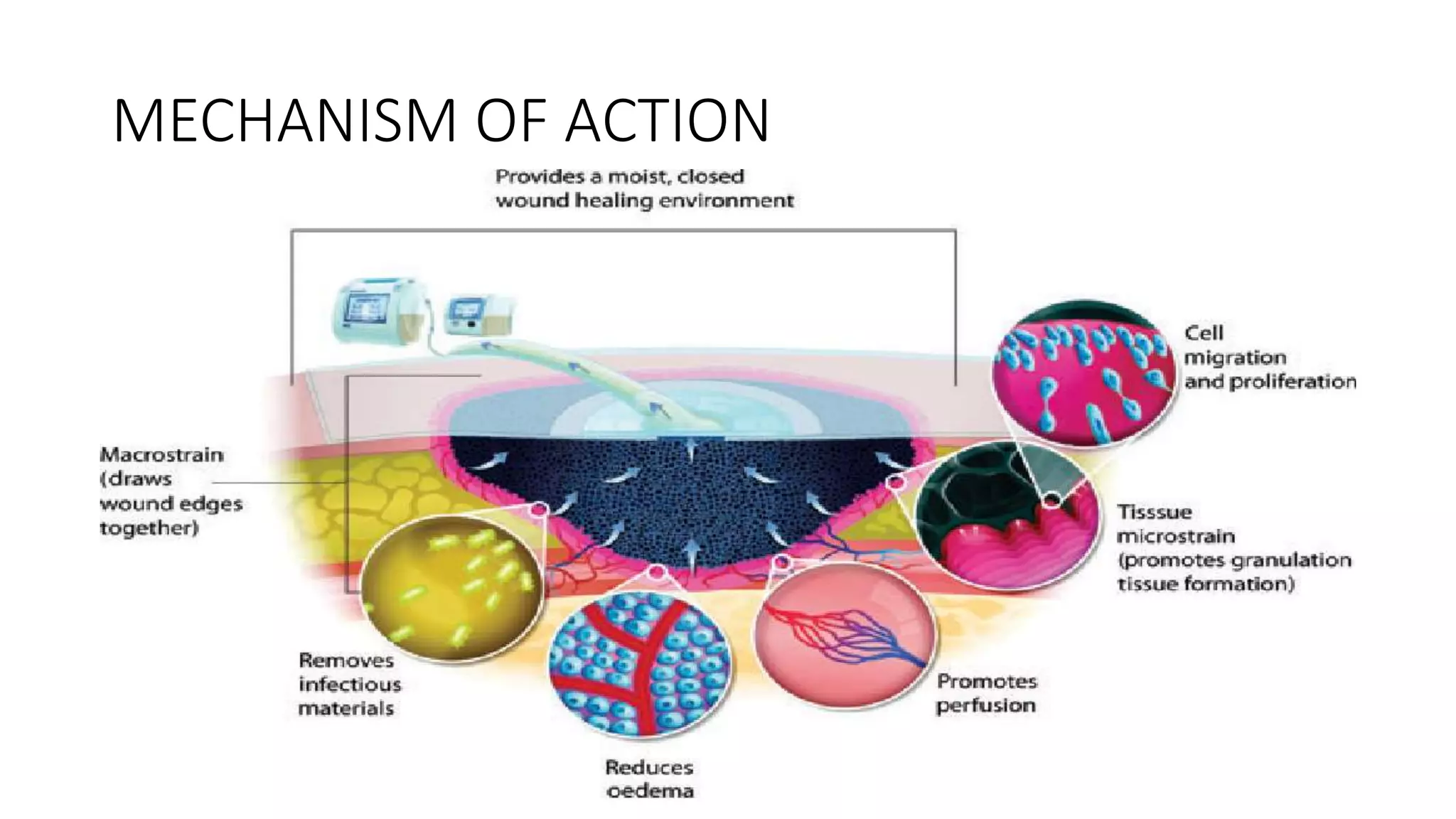 Negative pressure wound therapy | PPTX