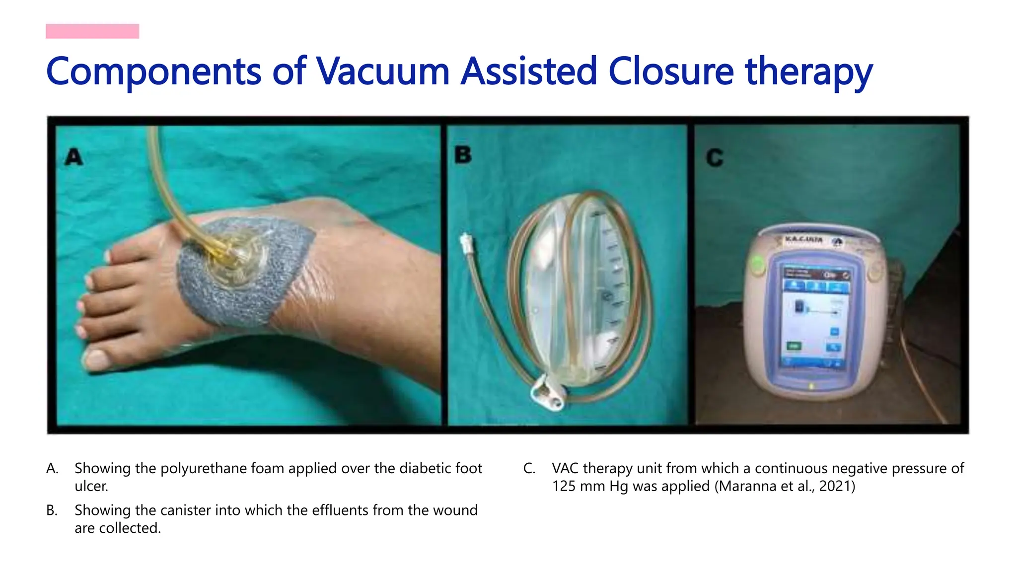 Negative Pressure Wound Therapy in Diabetic Foot Ulcer.pptx