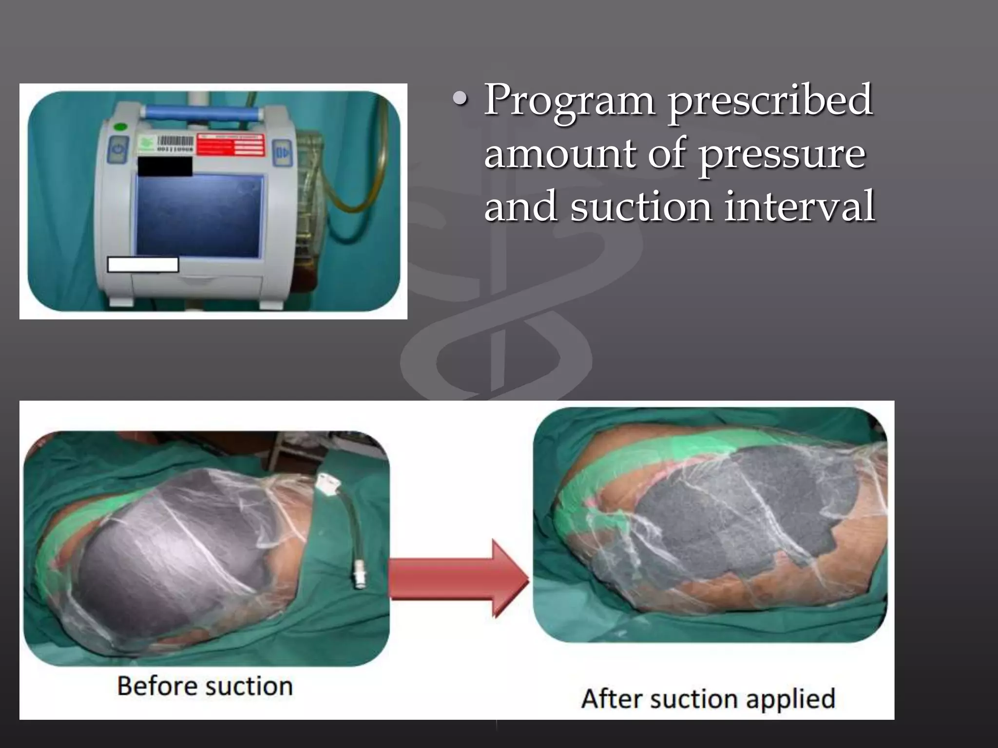 Negative Pressure Wound Therapy (NPWT) | PPTX