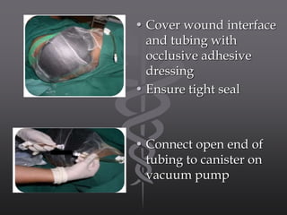 Negative Pressure Wound Therapy (NPWT) | PPTX