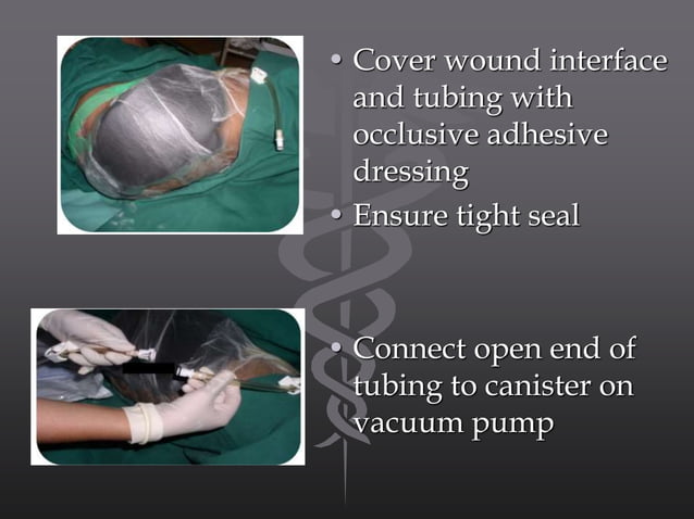 Negative Pressure Wound Therapy (NPWT) | PPTX | First Aid | Injuries