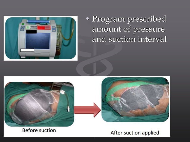 Negative Pressure Wound Therapy (NPWT) | PPTX | First Aid | Injuries