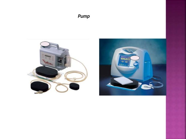 Negative pressure wound therapy(vac) | PPTX | Death, Injury, or ...