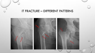 NEGLECTED INTERTROCHANTERIC fracture.pptx