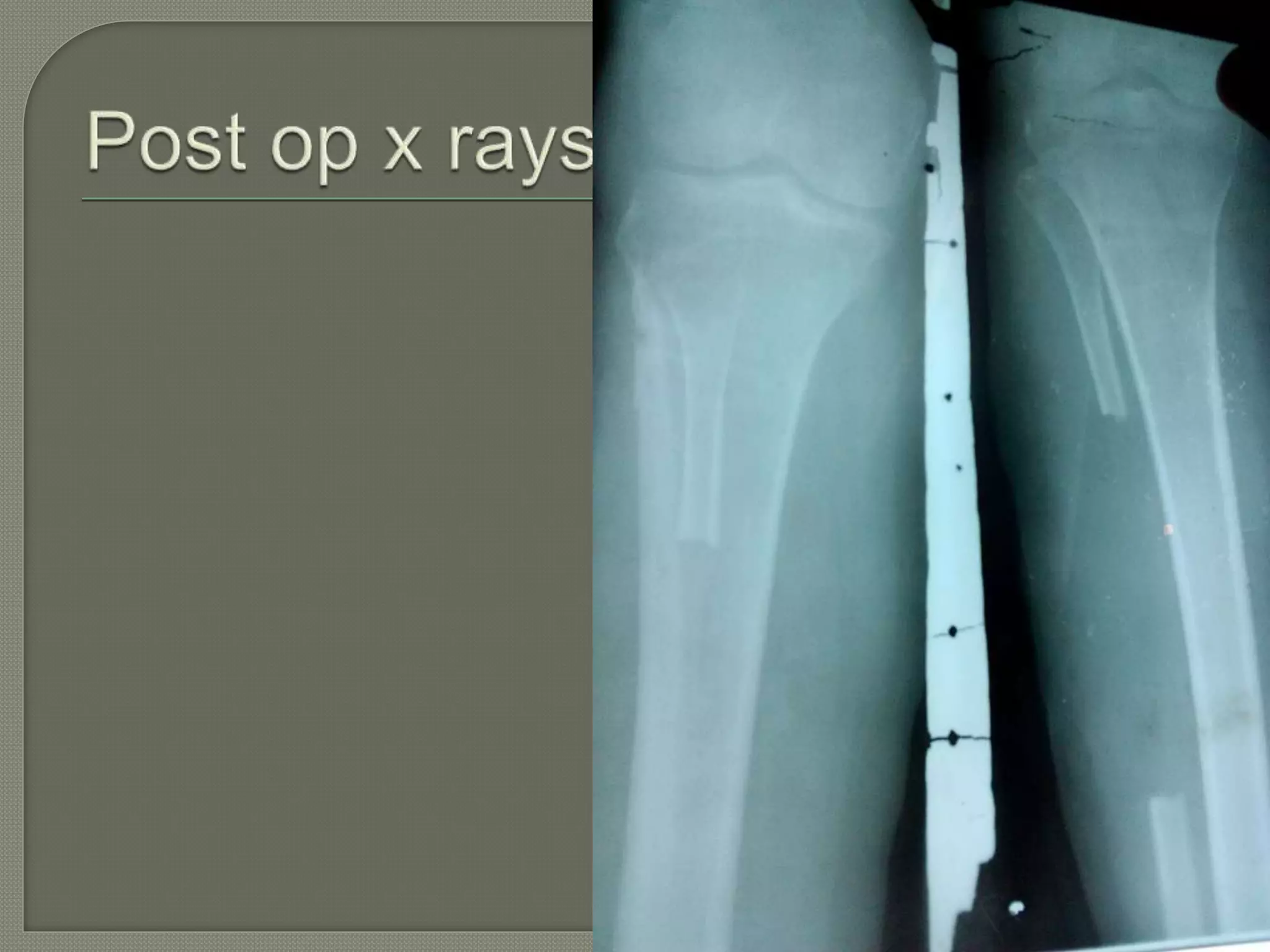Neglected fracture neck of femur in young adults | PPTX