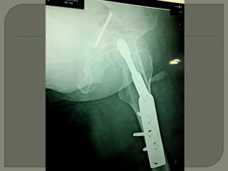 Neglected fracture neck of femur in young adults | PPTX