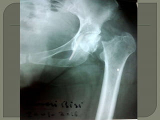 Neglected fracture neck of femur in young adults | PPTX