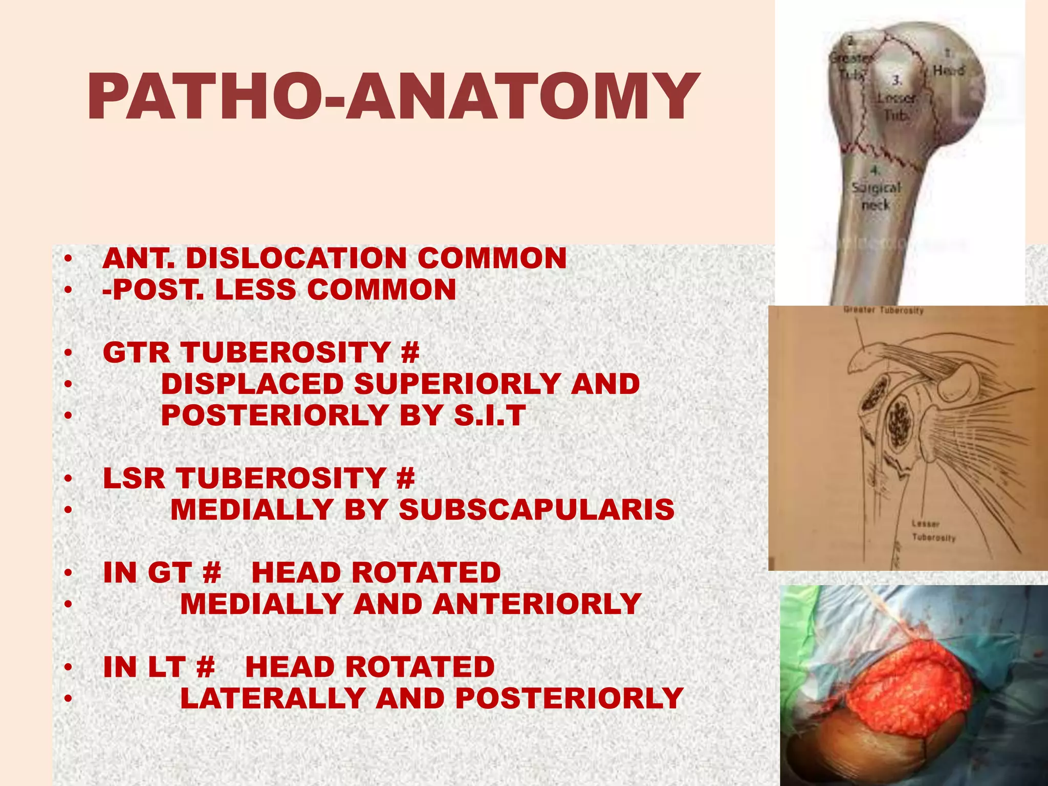 neglected proximal humerus fractures-a surgical challenge, dr mohamed ...